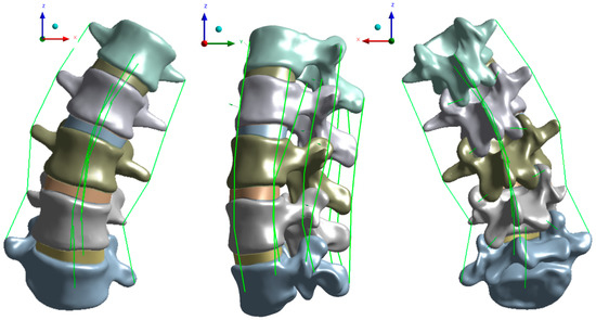 The Effect of Concave-Side Intertransverse Ligament Laxity on the ...