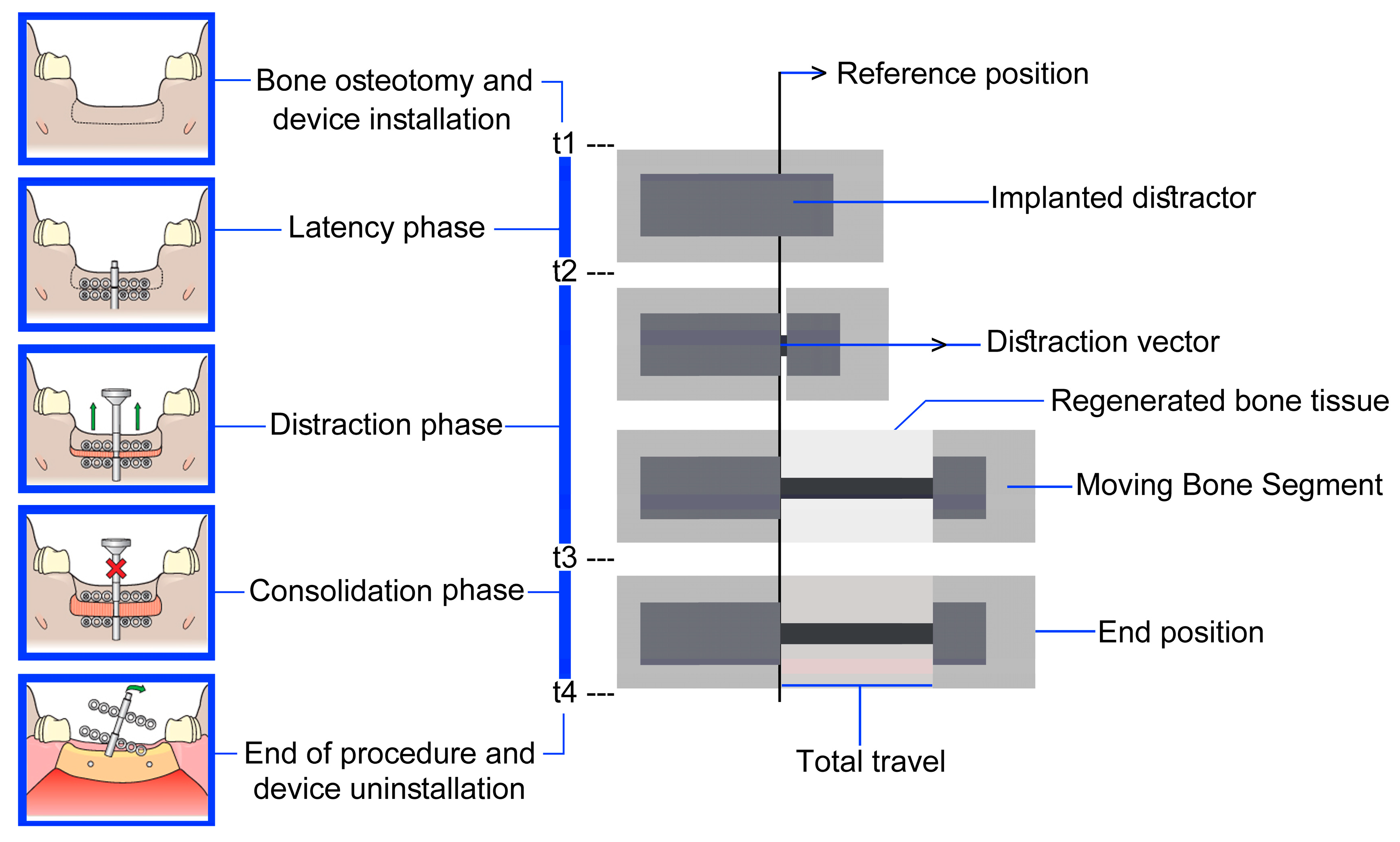 Hybrid Distractor for Continuous Mandibular Distraction Osteogenesis