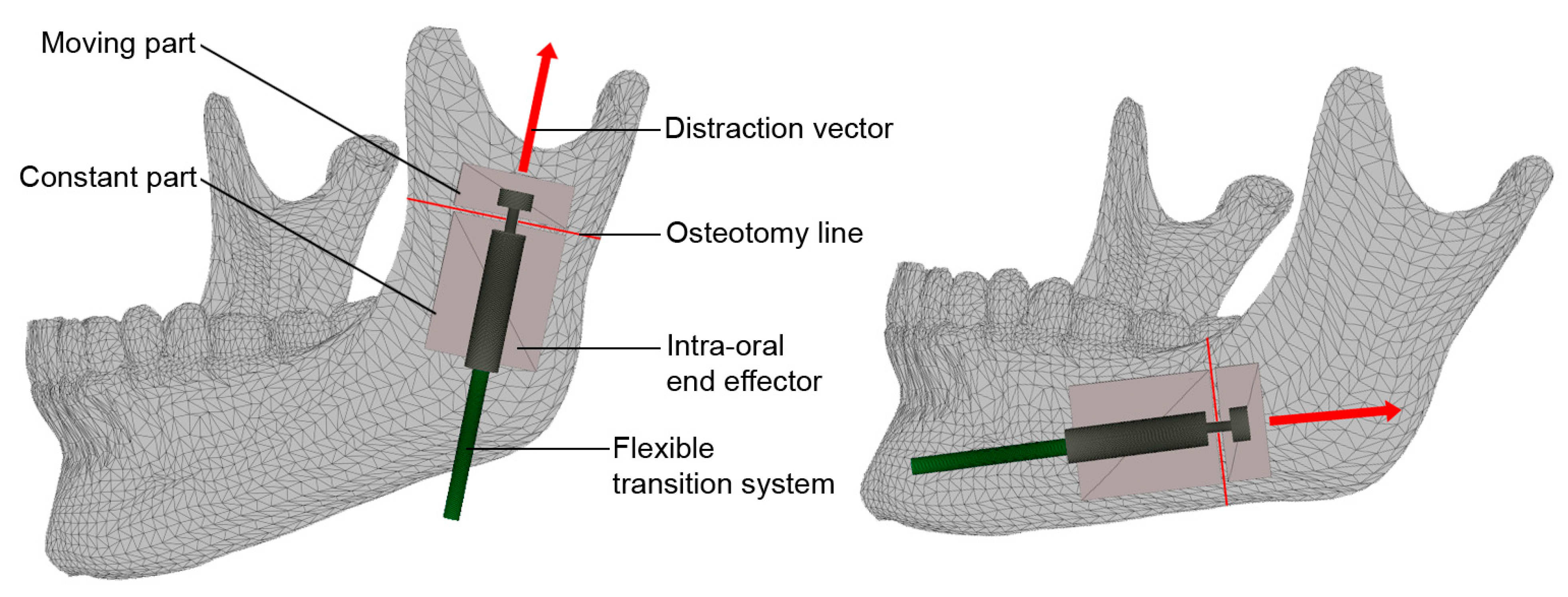 Hybrid Distractor for Continuous Mandibular Distraction Osteogenesis