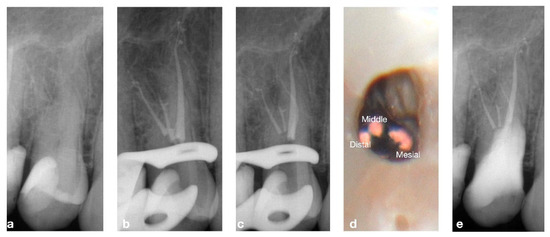 Maxillary Premolars with Four Canals: Case Series