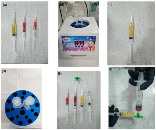 Platelet-Rich Plasma Gel Matrix (PRP-GM): Description of a New Technique