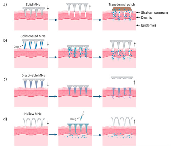 Metallic Microneedles for Transdermal Drug Delivery: Applications ...