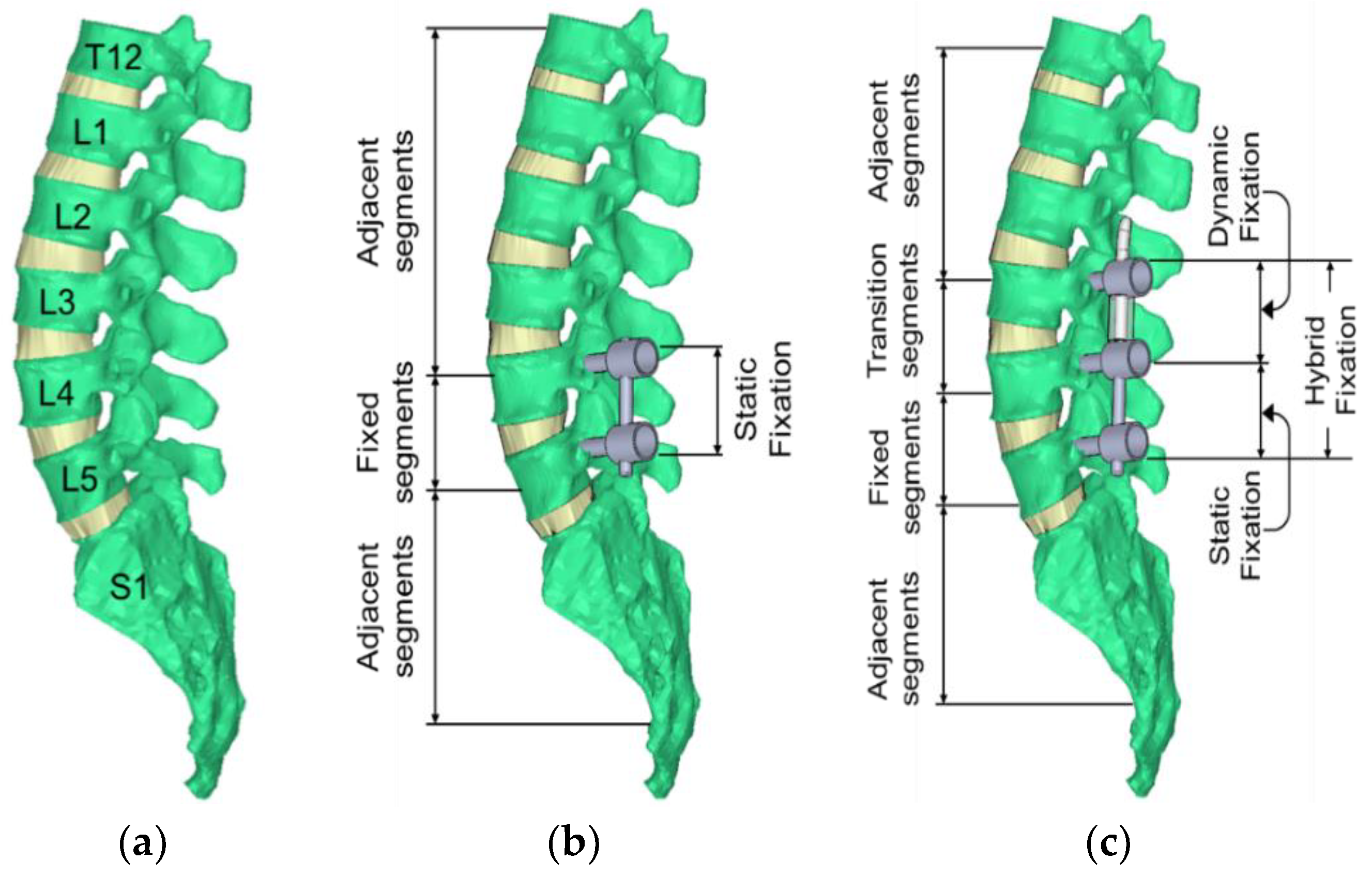 Biomechanical Effect of Hybrid Dynamic Stabilization Implant on the ...
