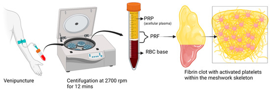 Evolution and Clinical Advances of Platelet-Rich Fibrin in ...