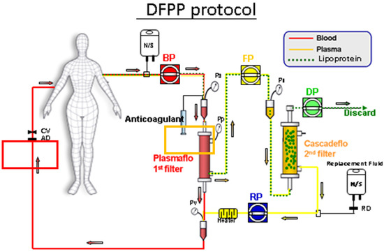 Double Filtration Plasmapheresis with Polyvinyl Alcohol-Based Membrane ...