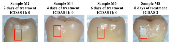 Detection of Bacteria-Induced Early-Stage Dental Caries Using Three ...