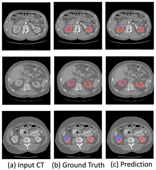 AI-Driven Robust Kidney and Renal Mass Segmentation and Classification ...