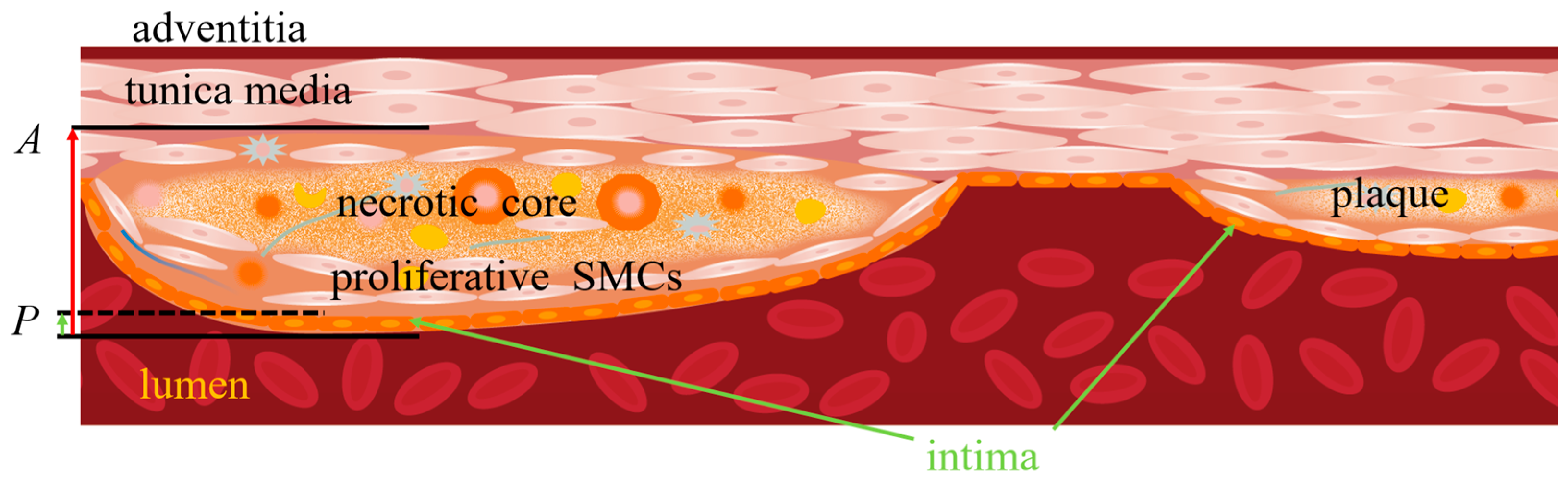 A New Conformal Penetrating Heating Strategy for Atherosclerotic Plaque