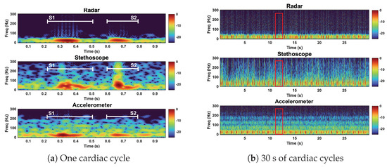 Contactless Stethoscope Enabled by Radar Technology