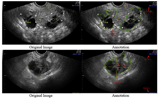 Improving the Segmentation Accuracy of Ovarian-Tumor Ultrasound Images ...