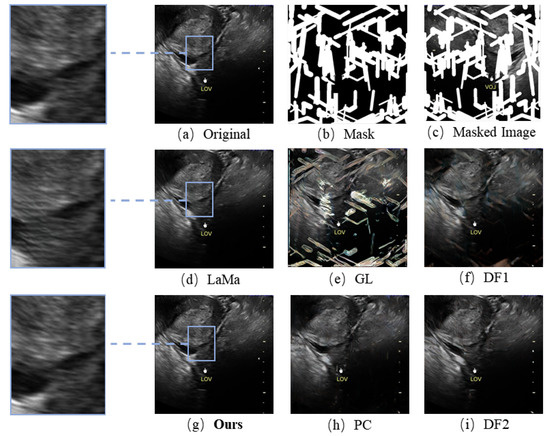 Improving the Segmentation Accuracy of Ovarian-Tumor Ultrasound Images ...