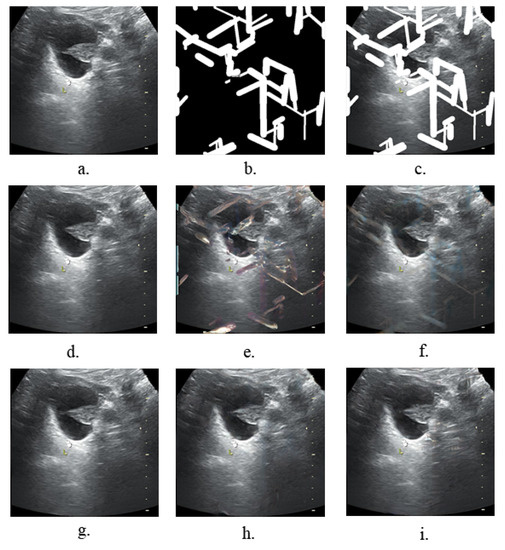 Improving the Segmentation Accuracy of Ovarian-Tumor Ultrasound Images ...