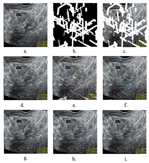 Improving the Segmentation Accuracy of Ovarian-Tumor Ultrasound Images ...