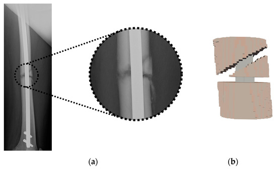 Three-Dimensional Computational Model Simulating the Initial Callus Growth during Fracture ...