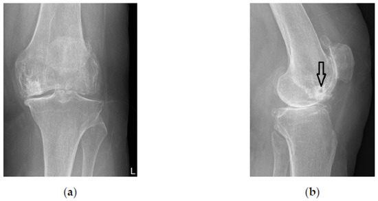 Tissue Integration of Calcium Phosphate Compound after Subchondroplasty ...