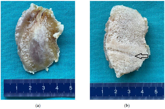 Tissue Integration of Calcium Phosphate Compound after Subchondroplasty ...