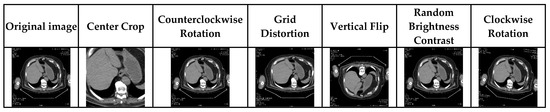 Fully Automatic Liver and Tumor Segmentation from CT Image Using an AIM ...