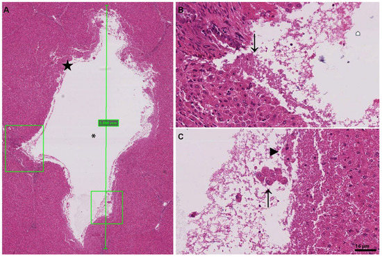 Liver Ultrasound Histotripsy: Novel Analysis of the Histotripsy Site ...