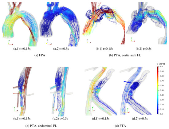 Comparative Analysis of Patient-Specific Aortic Dissections through ...