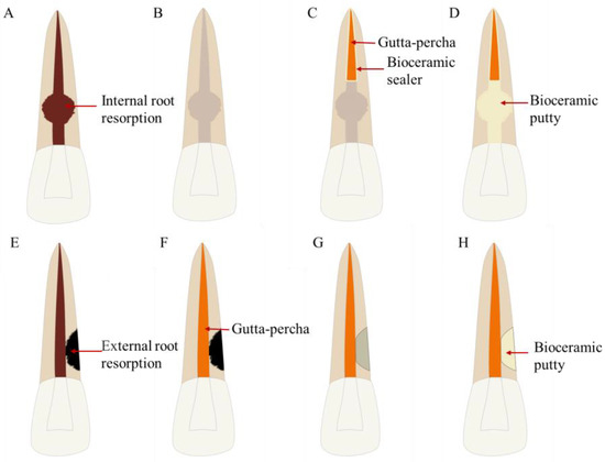 Bioceramics in Endodontics: Updates and Future Perspectives