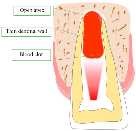 Photobiomodulation Therapy and Pulp-Regenerative Endodontics: A ...