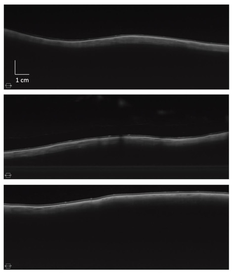 Swept-Source OCT Mid-Peripheral Retinal Irregularity in Retinal ...