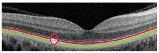 On Machine Learning in Clinical Interpretation of Retinal Diseases ...