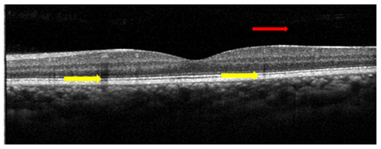 On Machine Learning in Clinical Interpretation of Retinal Diseases ...