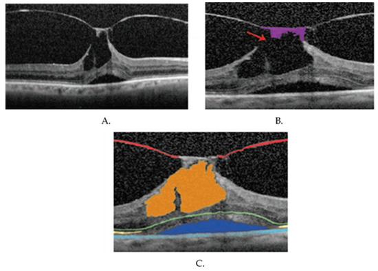 On Machine Learning in Clinical Interpretation of Retinal Diseases ...