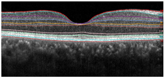 On Machine Learning in Clinical Interpretation of Retinal Diseases ...