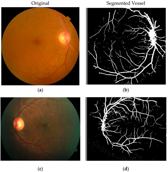 Automated Diagnosis of Diabetic Retinopathy Using Deep Learning: On the ...