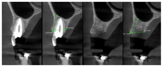 Socket Preservation after Tooth Extraction: Particulate Autologous Bone ...