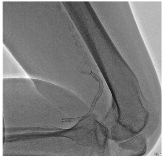 Effects of Tapered-Strut Design on Fatigue Life Enhancement of ...