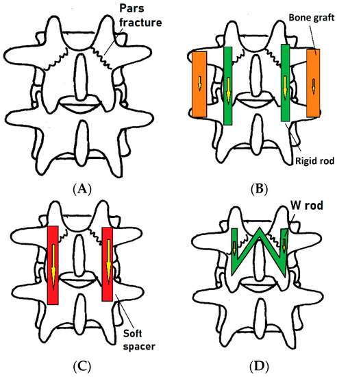 Biomechanical Effects of a Novel Pedicle Screw W-Type Rod Fixation for ...
