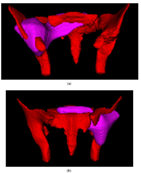 Establishment of Surgical Difficulty Grading System and Application of ...