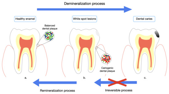 Bioengineering | Free Full-Text | Analysis of Dental Enamel Remineralization: A Systematic ...