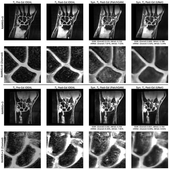 Synthetic Inflammation Imaging with PatchGAN Deep Learning Networks