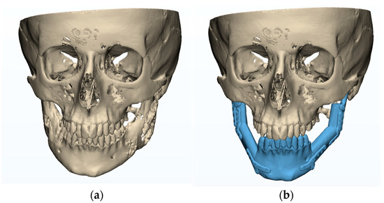 Biomechanical Evaluation of Temporomandibular Joint Reconstruction ...