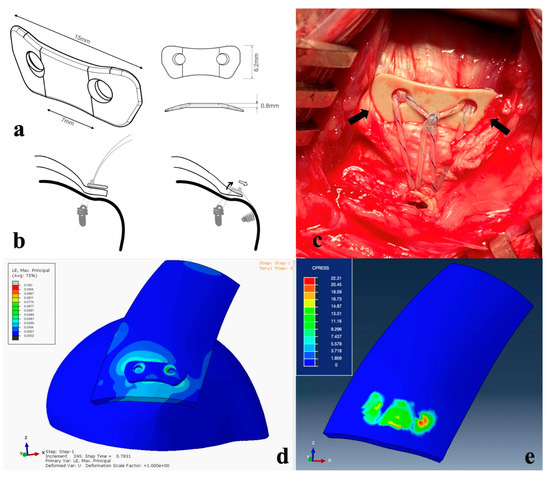 Global Compressive Loading from an Ultra-Thin PEEK Button Augment ...