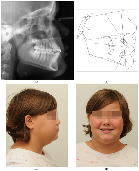 Concept for the Treatment of Class III Anomalies with a Skeletally ...