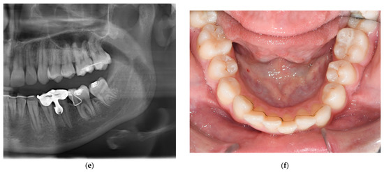 Concept for the Treatment of Class III Anomalies with a Skeletally ...