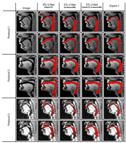 Automatic Multiple Articulator Segmentation in Dynamic Speech MRI Using ...