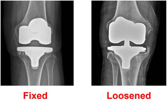 Machine Learning for Detecting Total Knee Arthroplasty Implant ...