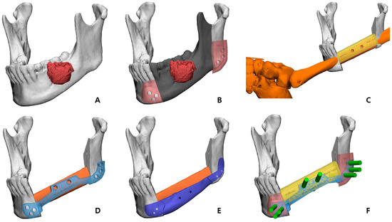 Long-Term Follow-Up of a Novel Surgical Option Combining Fibula Free ...