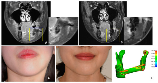 Long-Term Follow-Up of a Novel Surgical Option Combining Fibula Free ...