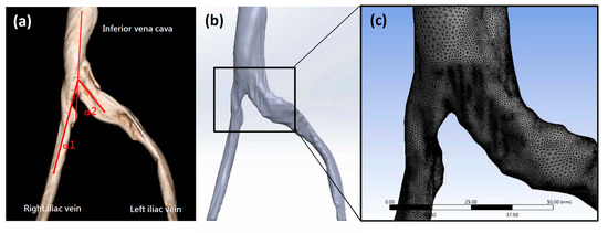 CFD Study of the Effect of the Angle Pattern on Iliac Vein Compression ...