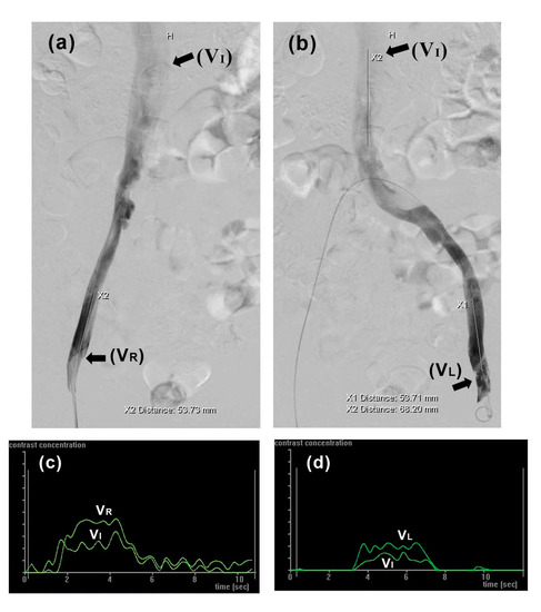 CFD Study of the Effect of the Angle Pattern on Iliac Vein Compression ...