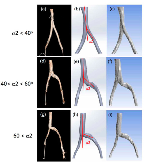 CFD Study of the Effect of the Angle Pattern on Iliac Vein Compression ...