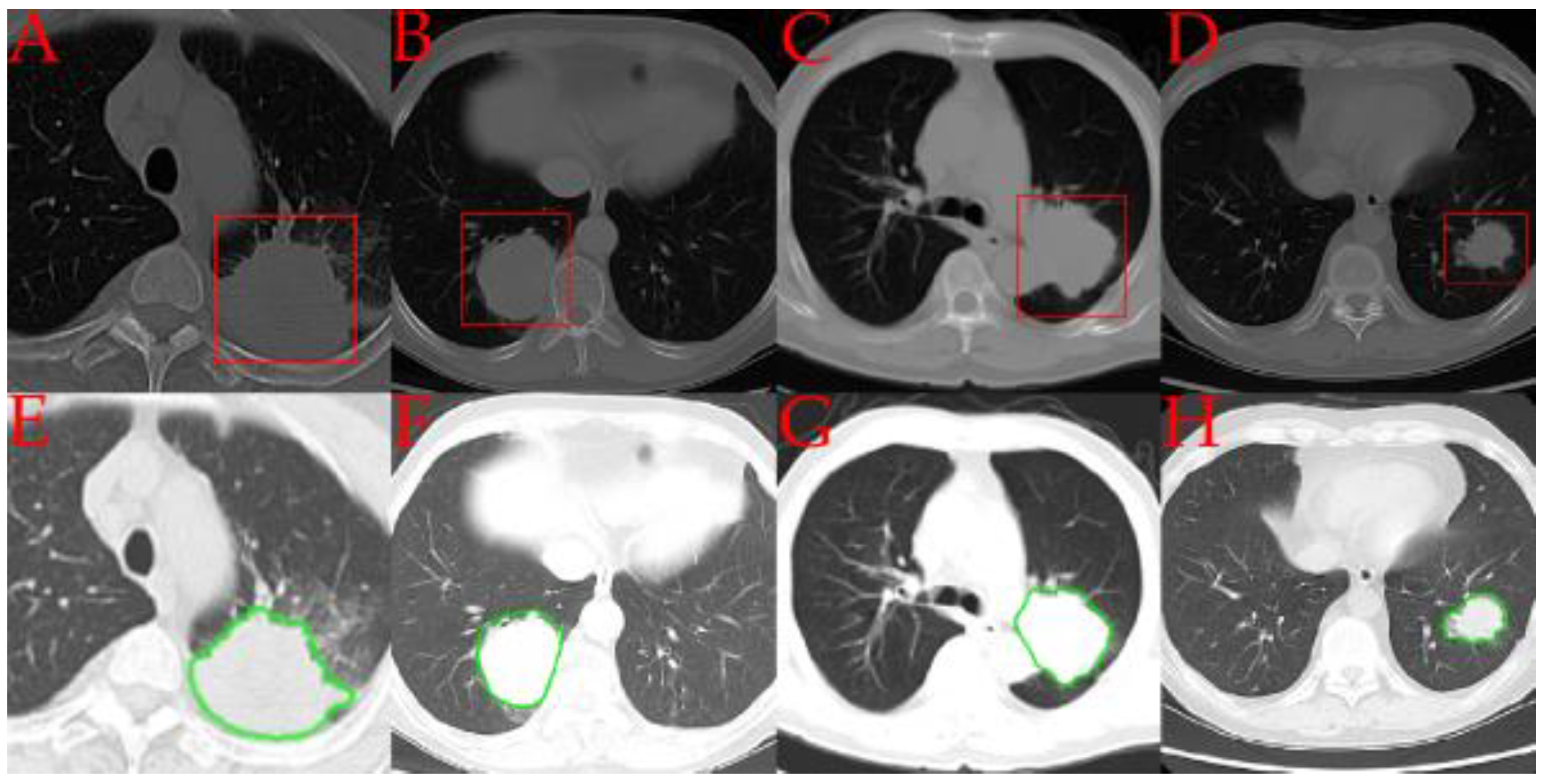 Automated Classification of Lung Cancer Subtypes Using Deep Learning and CT-Scan Based Radiomic ...