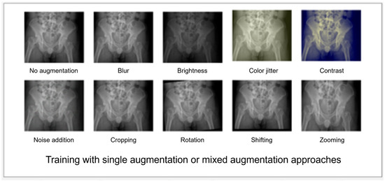 The Application of Design Thinking in Developing a Deep Learning Algorithm for Hip Fracture ...